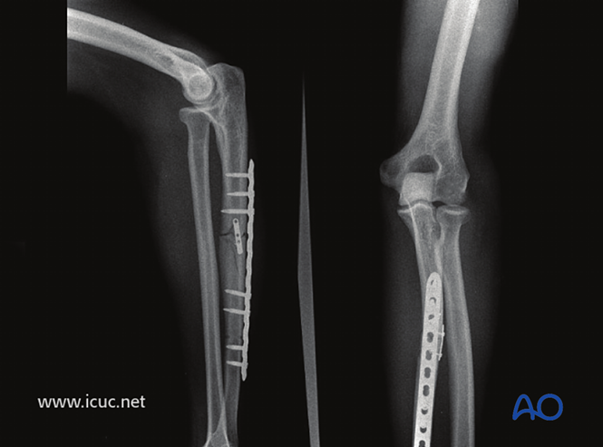 ORIF - Plating for Simple fracture of the ulna, with dislocation of ...