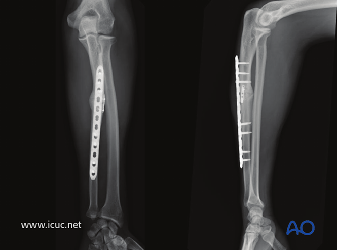 ORIF - Plating for Simple fracture of the ulna, with dislocation of ...