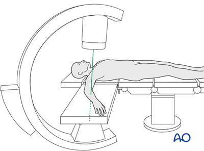 MIO - Minimally invasive compression plating for Transverse simple ...