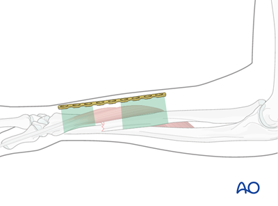 MIO - Minimally invasive compression plating for Transverse simple ...