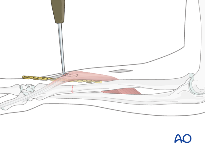 MIO - Minimally invasive compression plating for Transverse simple ...