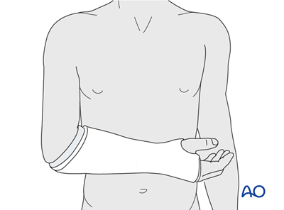 Nonoperative treatment for Transverse simple fracture of the ulna