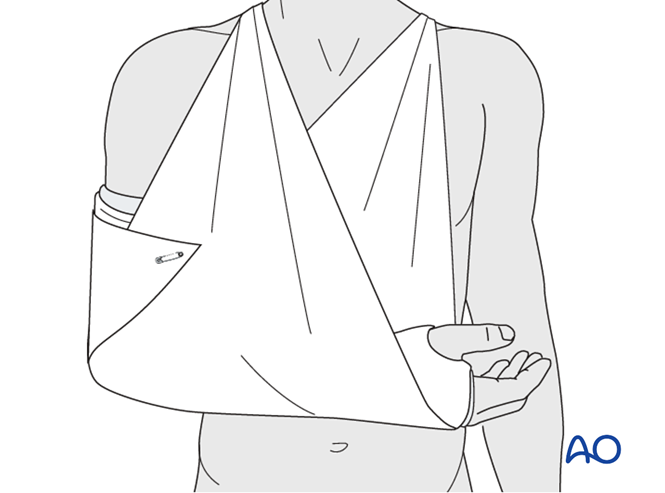 Nonoperative treatment for Simple fracture of the ulna, with ...