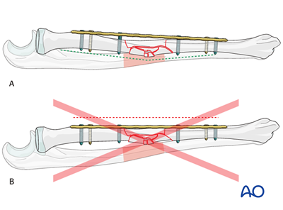 ORIF - Bridge plating for Multifragmentary, fragmentary segmental ...