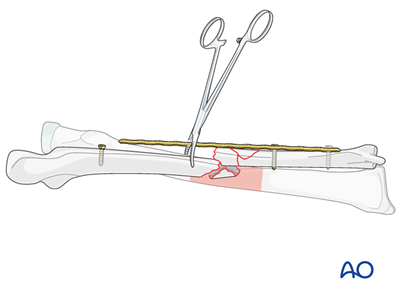 ORIF - Bridge plating for Multifragmentary, fragmentary segmental ...