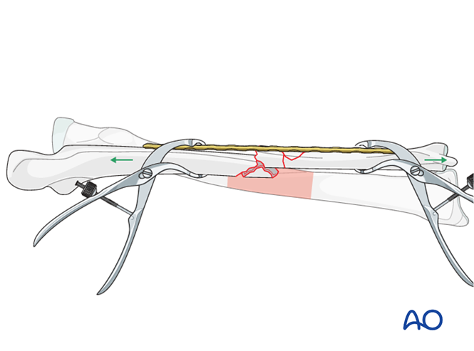 ORIF - Bridge plating for Multifragmentary, fragmentary segmental ...