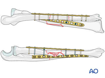 ORIF - Plating for Multifragmentary, intact segmental fracture of one ...