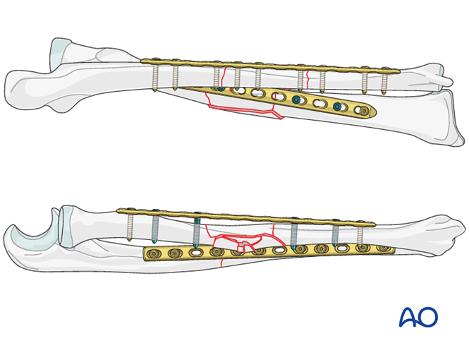 ORIF - Plating for Multifragmentary, intact segmental fracture of one ...