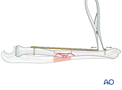 ORIF - Bridge plating for Multifragmentary, fragmentary segmental ...
