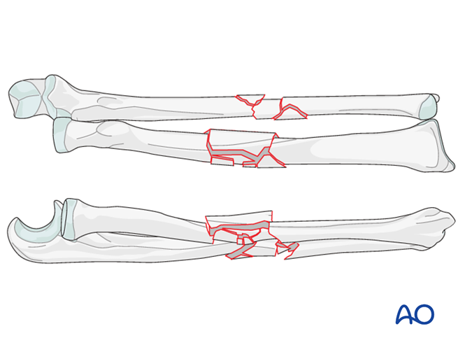 ORIF - Bridge plating for Multifragmentary, fragmentary segmental ...