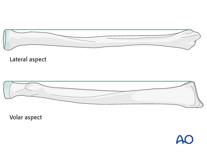 Comminuted radial fracture: bridge plating