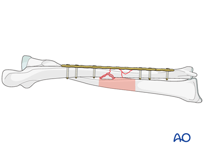 Comminuted ulnar fracture: bridge plating
