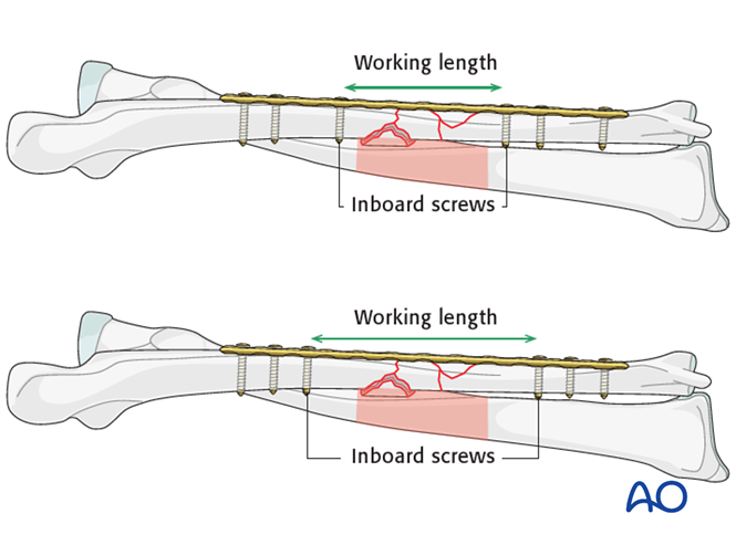 Comminuted ulnar fracture: bridge plating