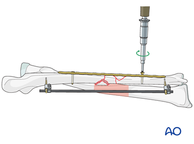 Comminuted ulnar fracture: bridge plating