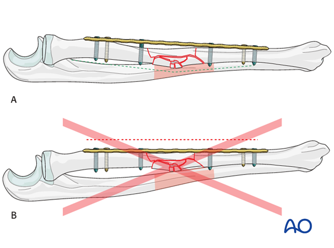 Comminuted radial fracture: bridge plating