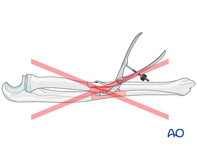 Comminuted radial fracture: bridge plating