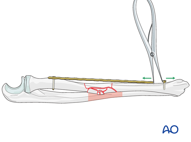 Comminuted radial fracture: bridge plating