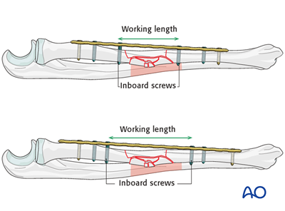 Comminuted radial fracture: bridge plating