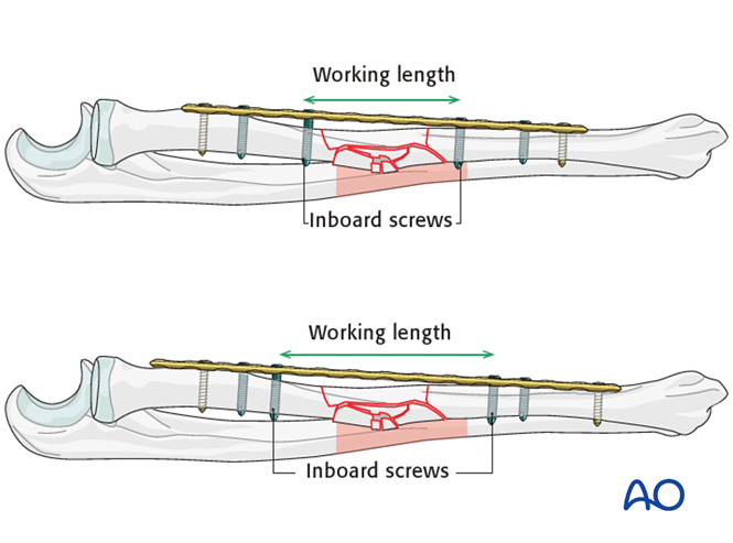 Comminuted radial fracture: bridge plating