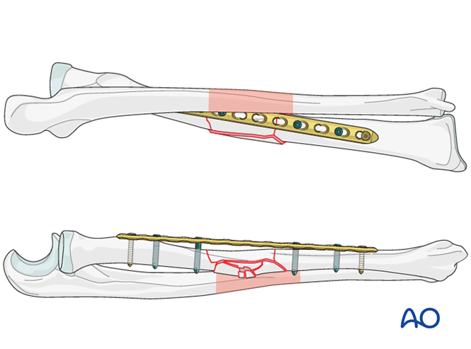 Comminuted radial fracture: bridge plating