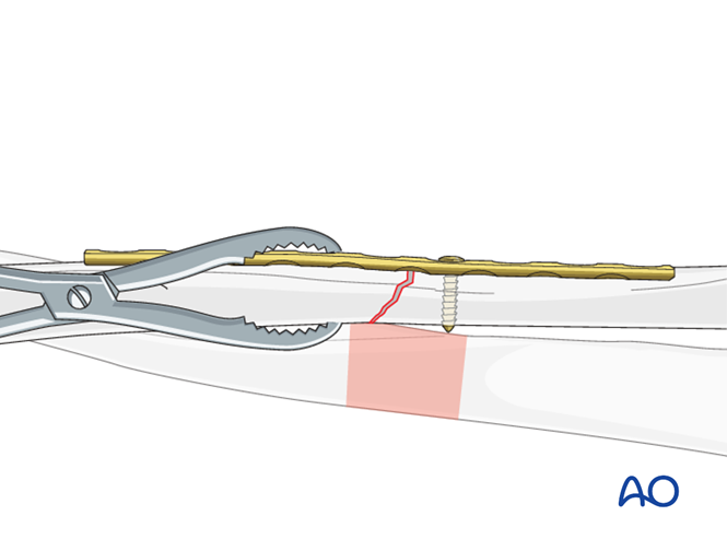 Oblique ulnar fracture: lag screw and plate fixation