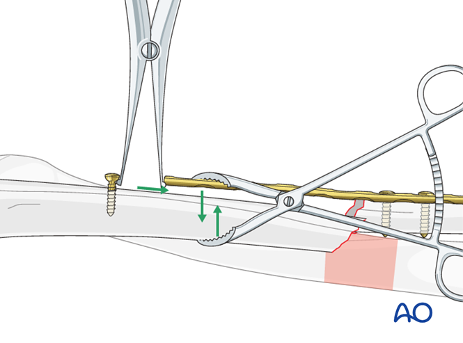 Oblique ulnar fracture: lag screw and plate fixation