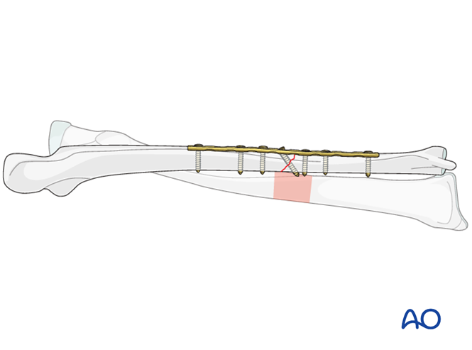 ORIF - Plating for Simple fracture of the ulna, with dislocation of ...