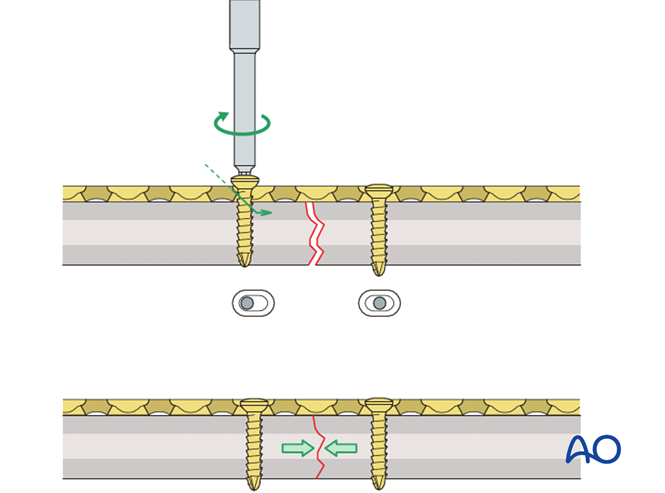 ORIF - Compression plating for Transverse simple fracture of the ulna