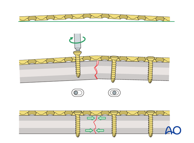 ORIF - Compression plating for Transverse simple fracture of the radius