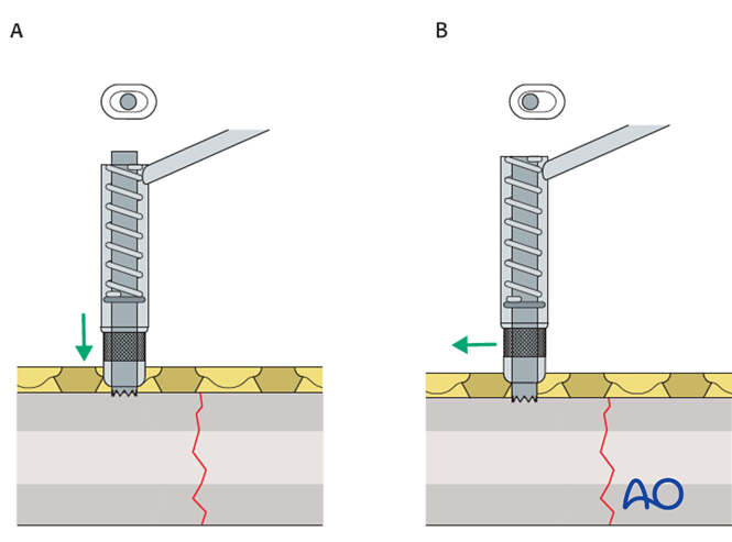 Transverse radial fracture: compression plating