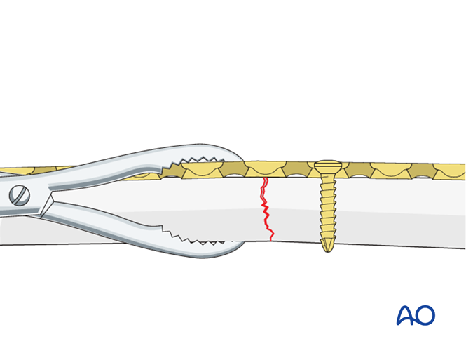 ORIF - Compression plating for Transverse simple fracture of the radius