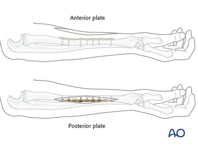 ORIF - Compression plating for Transverse simple fracture of the radius