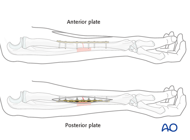 Transverse radial fracture: compression plating