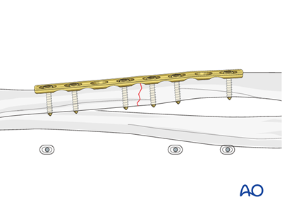 ORIF - Compression plating for Transverse simple fracture of the radius