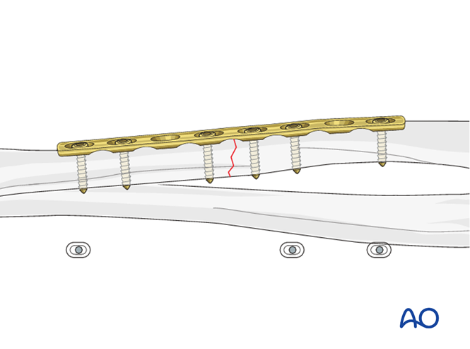 ORIF - Compression plating for Transverse simple fracture of the radius