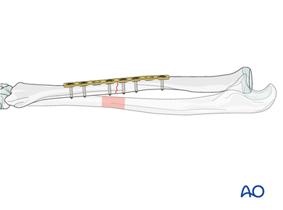 ORIF - Compression Plating for Simple fracture of the radius and the ulna
