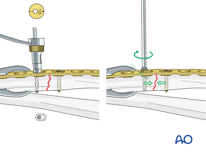 ORIF - Compression plating for Transverse simple fracture of the radius