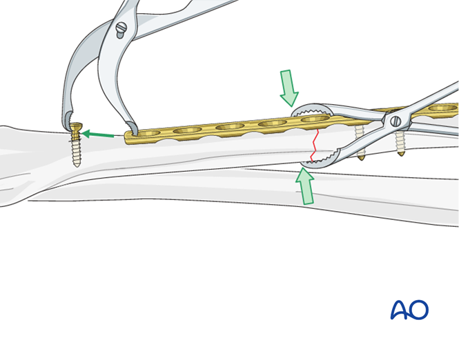ORIF - Compression plating for Transverse simple fracture of the radius