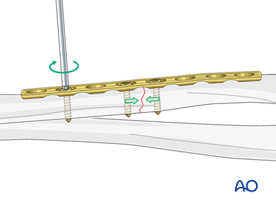 ORIF - Compression plating for Transverse simple fracture of the radius