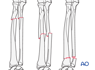 ORIF - Compression Plating for Simple fracture of the radius and the ulna