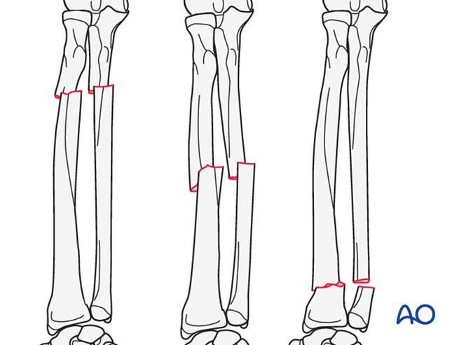 ORIF - Compression Plating for Simple fracture of the radius and the ulna