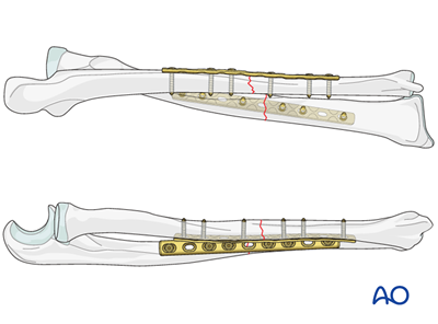ORIF - Compression Plating for Simple fracture of the radius and the ulna