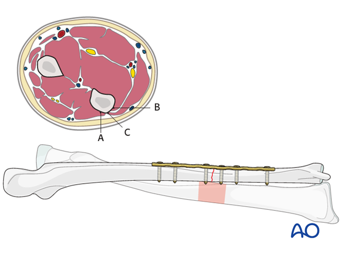 Transverse ulnar fracture: compression plating