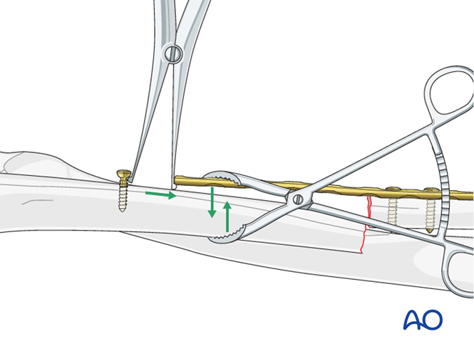 ORIF - Compression plating for Transverse simple fracture of the ulna