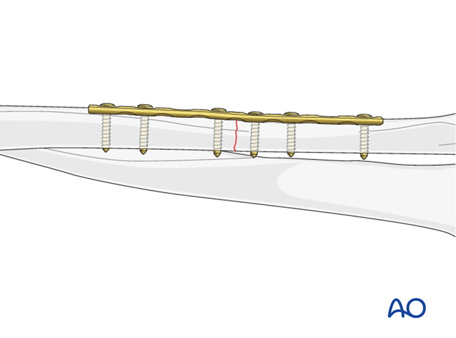 ORIF - Compression plating for Transverse simple fracture of the ulna