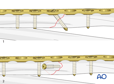 ORIF - Lag screw and plate fixation for Oblique simple fracture of the ...