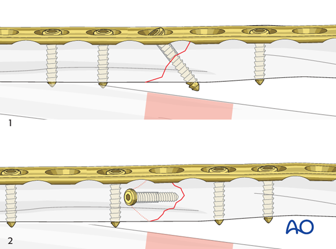 Oblique radial fracture: lag screw and plate fixation