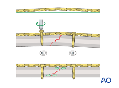 ORIF - Lag screw and plate fixation for Oblique simple fracture of the ...