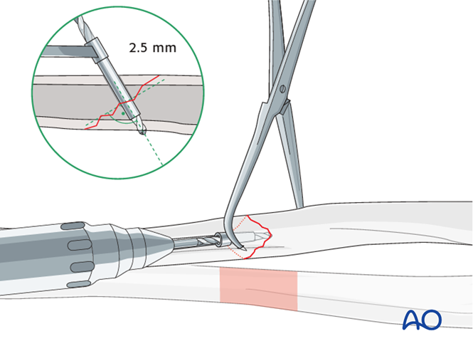 Oblique radial fracture: lag screw and plate fixation