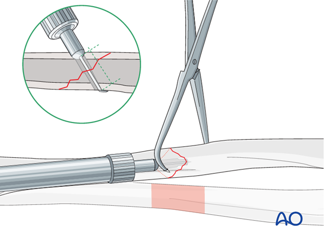 Oblique radial fracture: lag screw and plate fixation